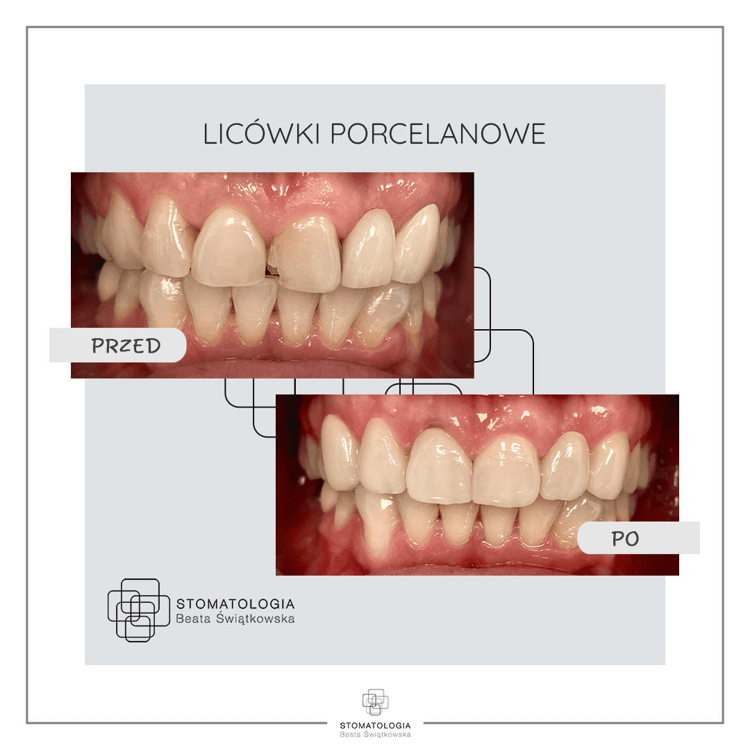 Licówki porcelanowe - Stomatologia Beata Świątkowska